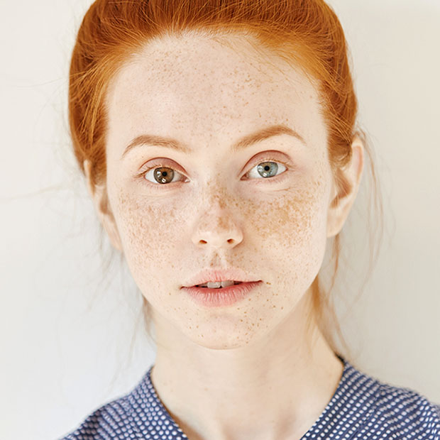 What Do You Know About Heterochromia? – Carteret NJ | Carteret Eyecare ...